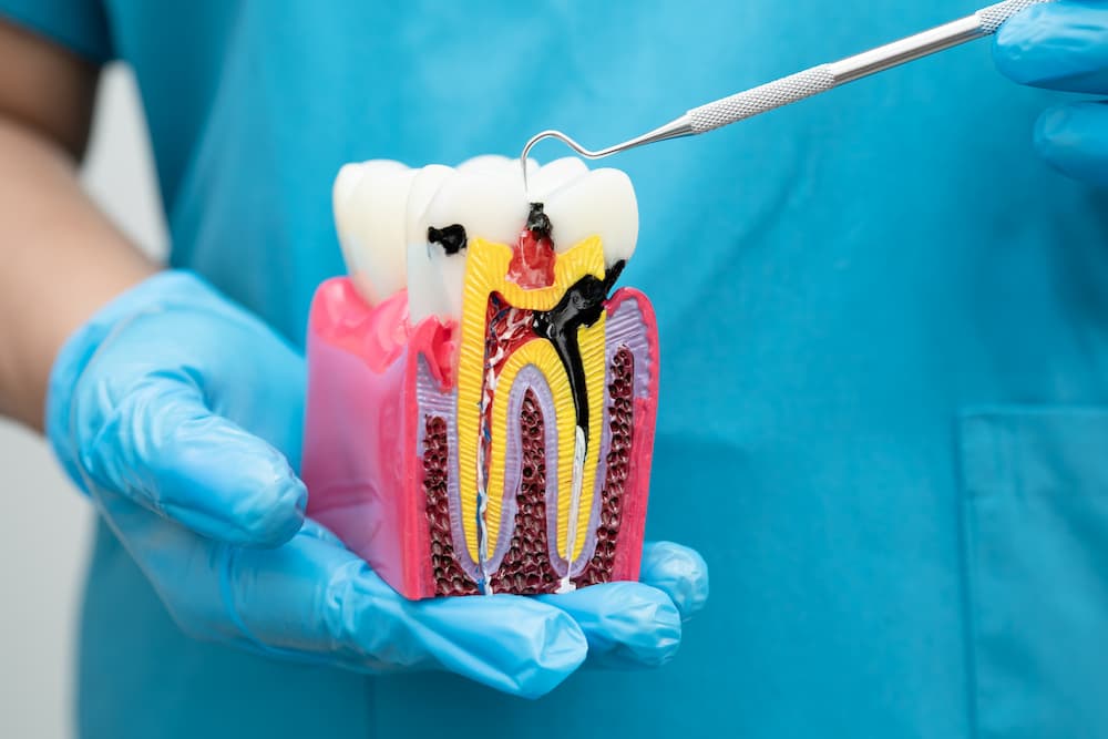 Endodoncia: ¿qué es y cuándo es necesario realizarla?